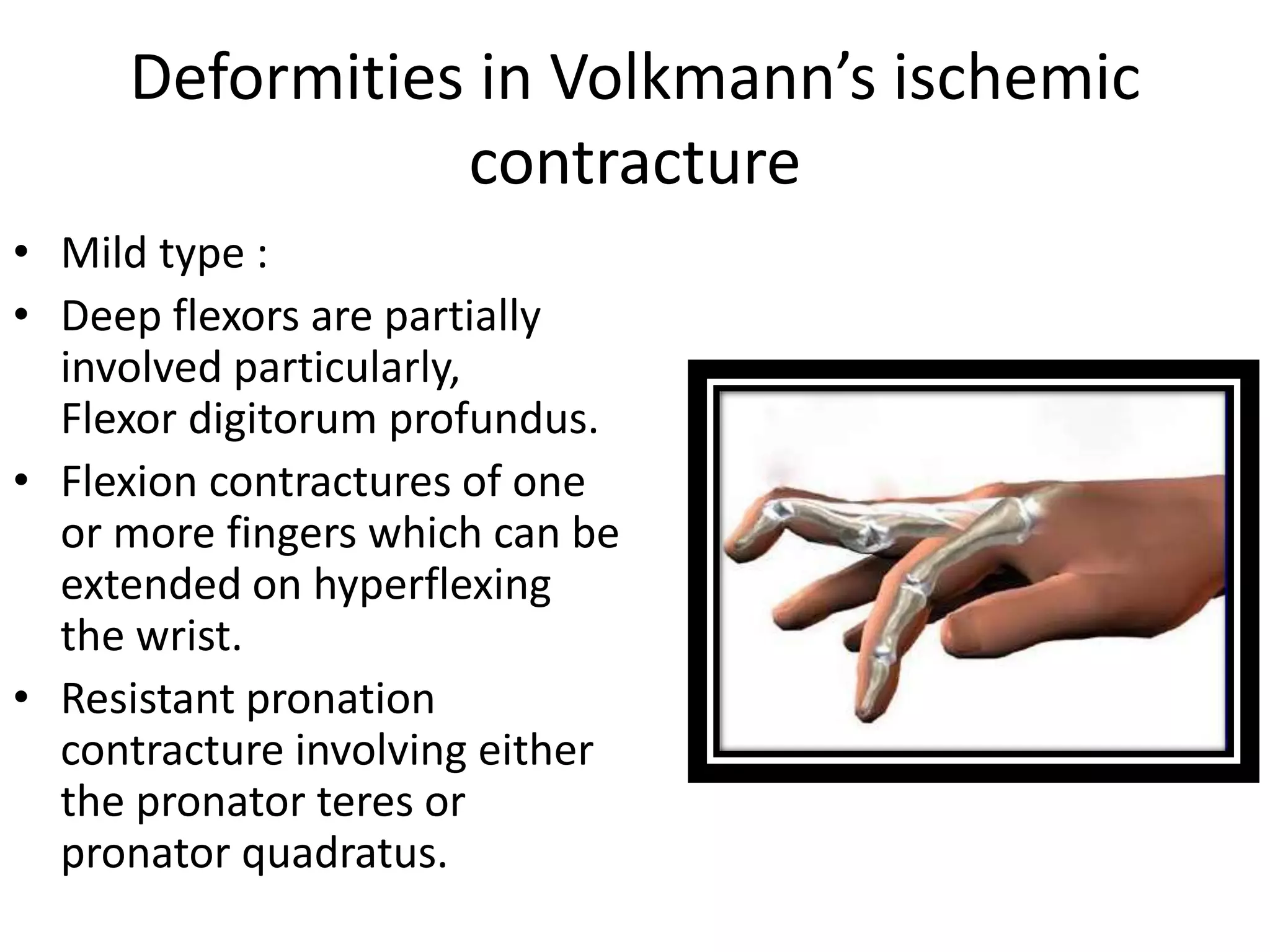 Volkmann¶s ischemic contracture | PPTX