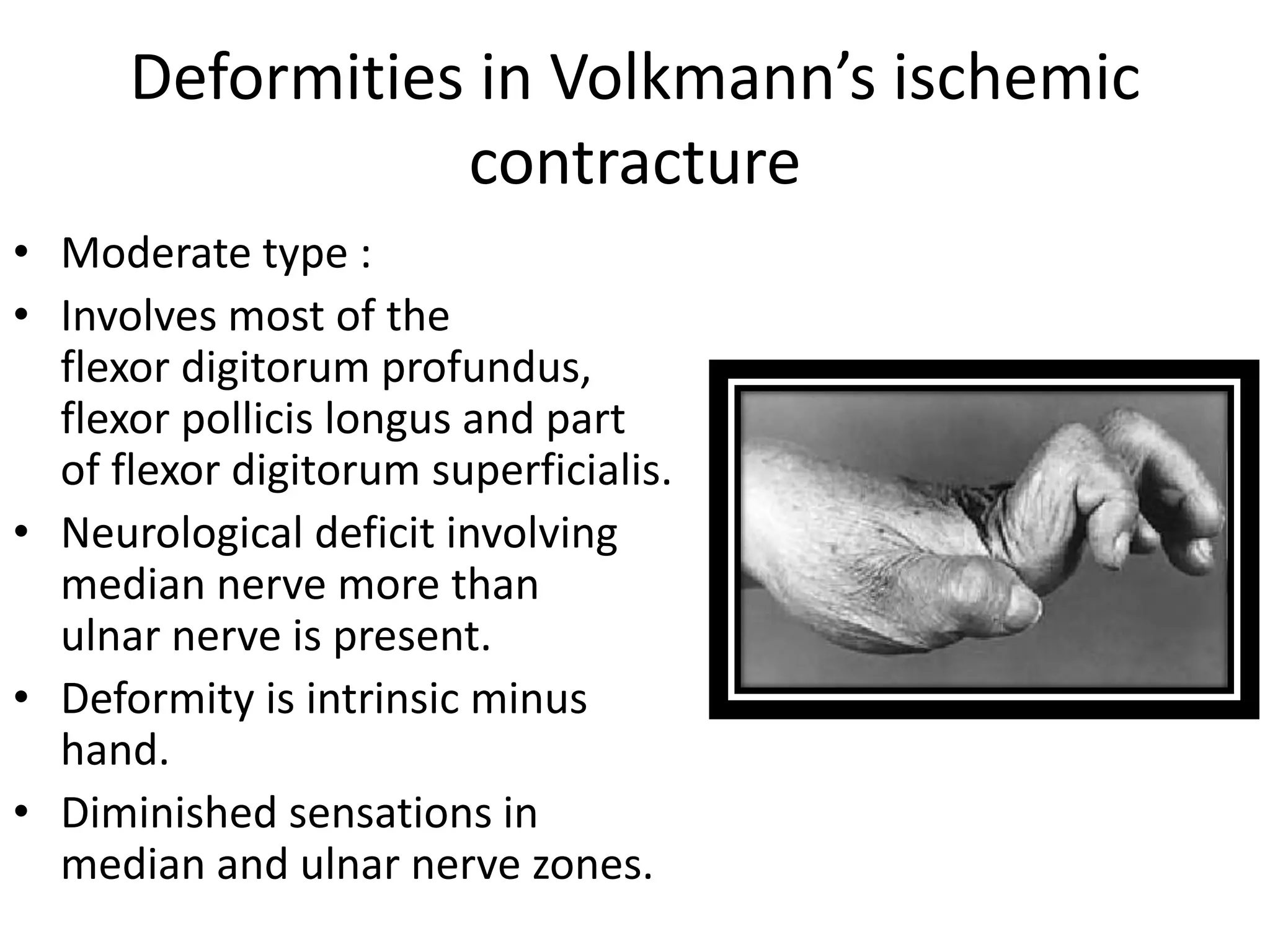 Volkmann¶s ischemic contracture | PPTX