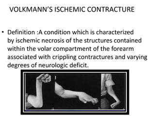 Volkmann¶s ischemic contracture | PPTX