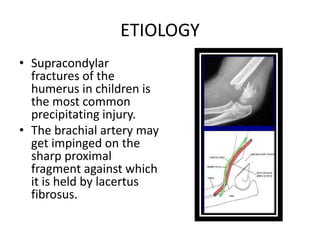 Volkmanns Ischemic Contracture