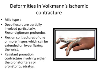 Volkmanns Ischemic Contracture