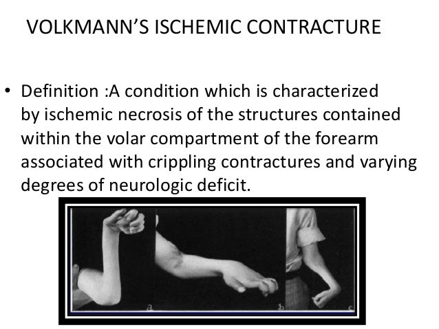 Volkmann¶s Ischemic Contracture
