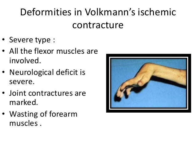Volkmanns Ischemic Contracture Microsurgery In Case Of Volkmann's