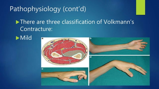 Volksmann contracture | PPTX