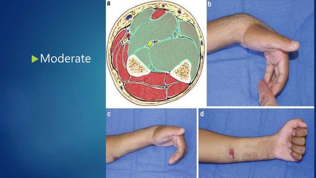 Volksmann contracture | PPTX