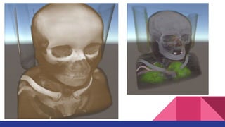 Volume Rendering in Unity3D | PDF