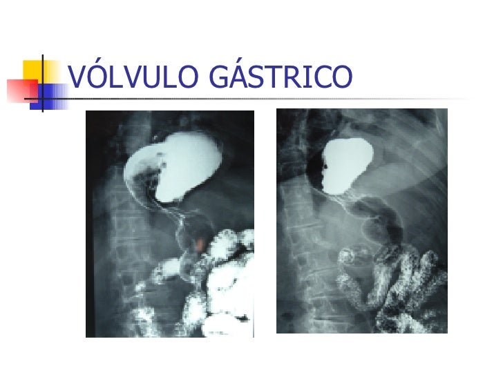 Volvulo Gastrico
