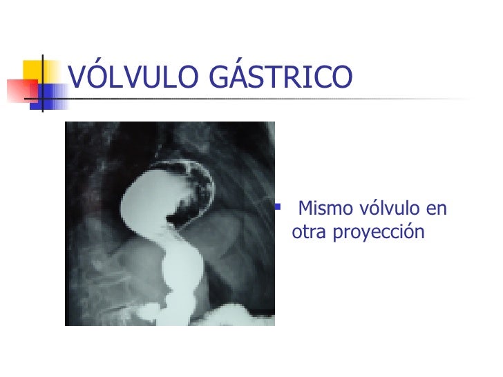 Volvulo Gastrico