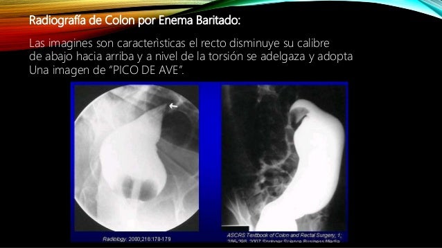 Volvulo de sigmoides y volvulo cecal