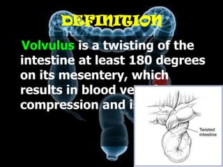 Volvulus | PPTX