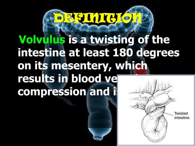 Volvulus | PPTX