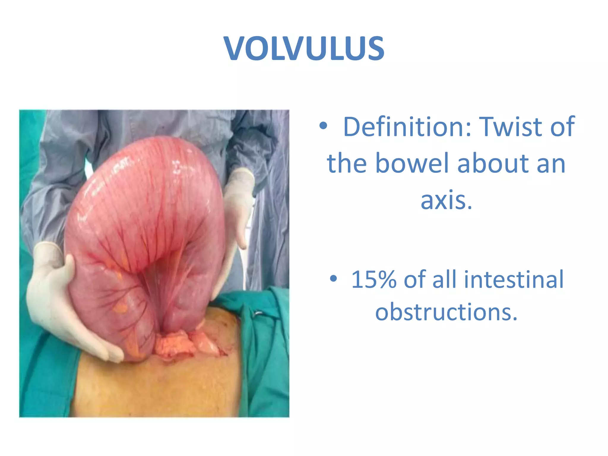 Volvulus | PPTX