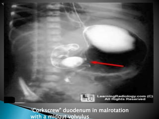 Midgut Volvulus X Ray