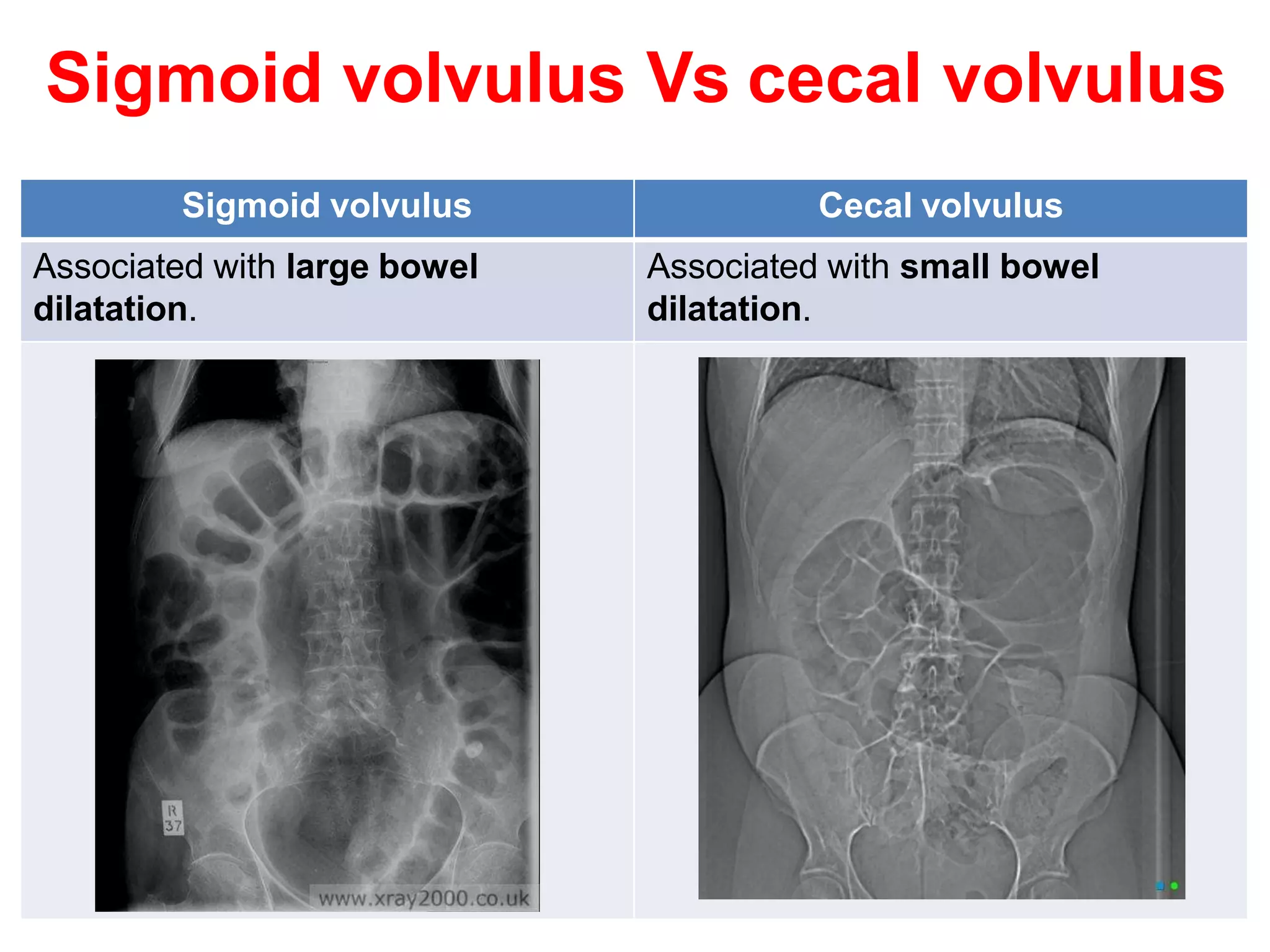 Volvulus of colon | PPTX