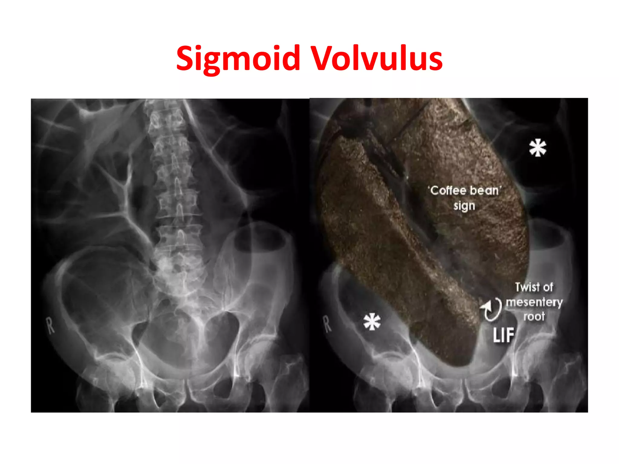 Volvulus of colon | PPTX
