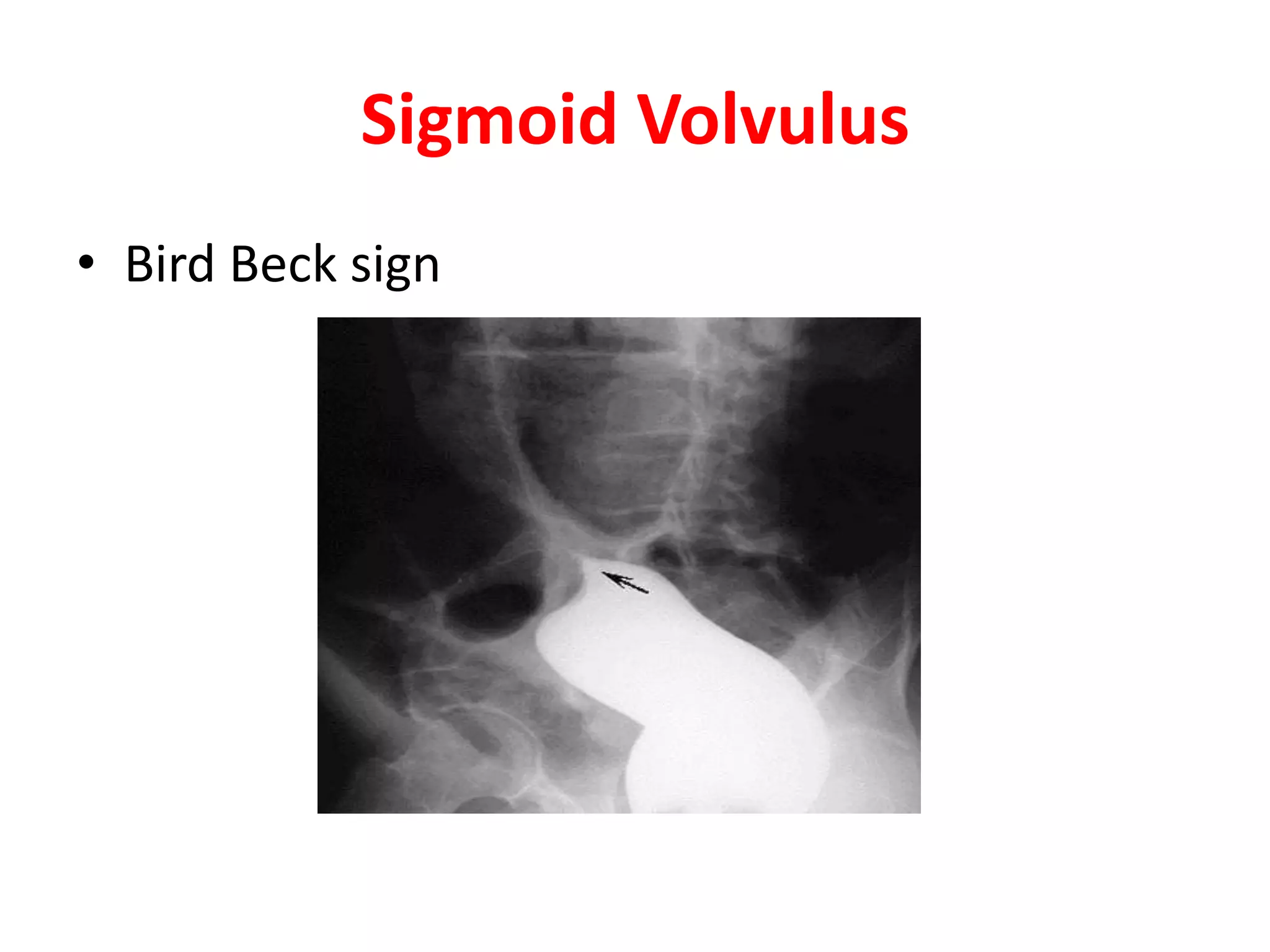 Volvulus of colon | PPTX