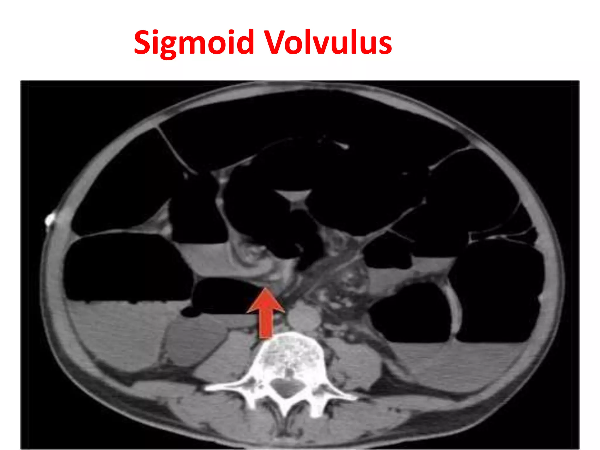 Volvulus of colon | PPTX