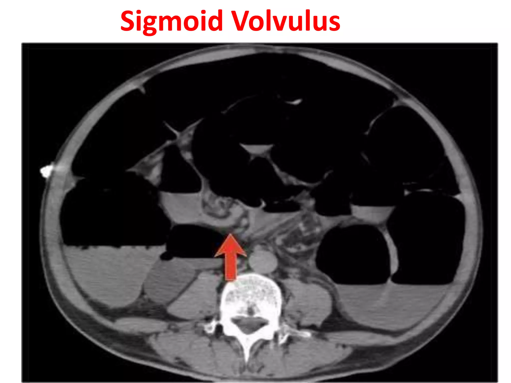 Volvulus of colon | PPTX