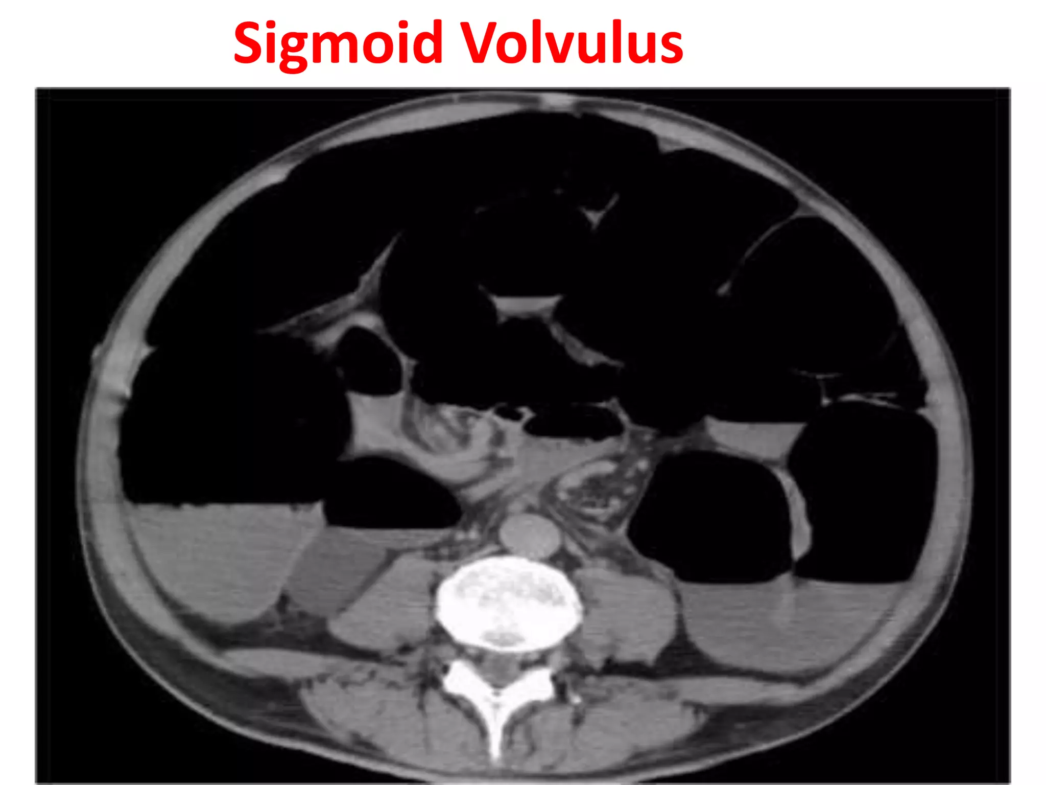 Volvulus of colon | PPTX