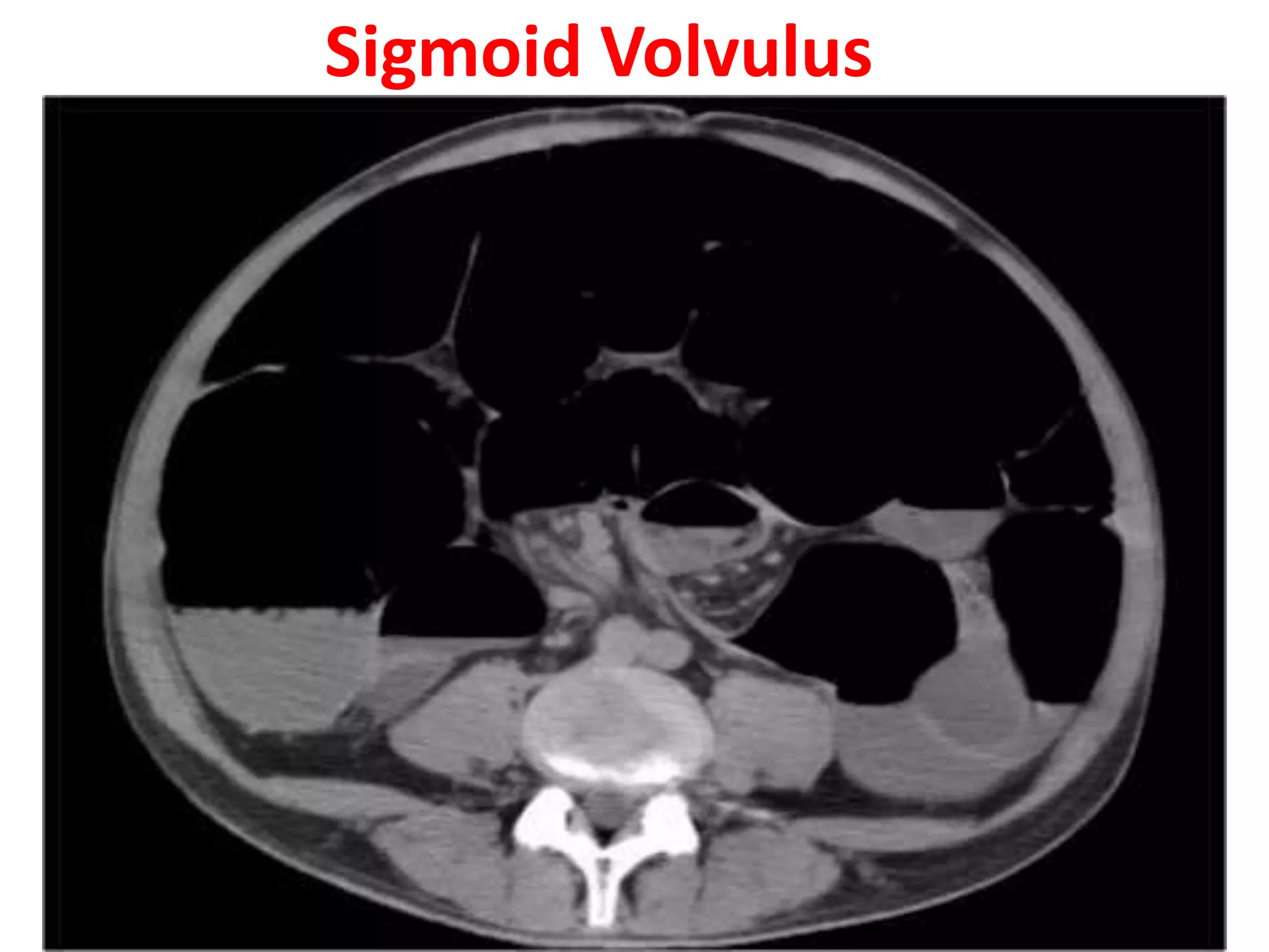 Volvulus of colon | PPTX