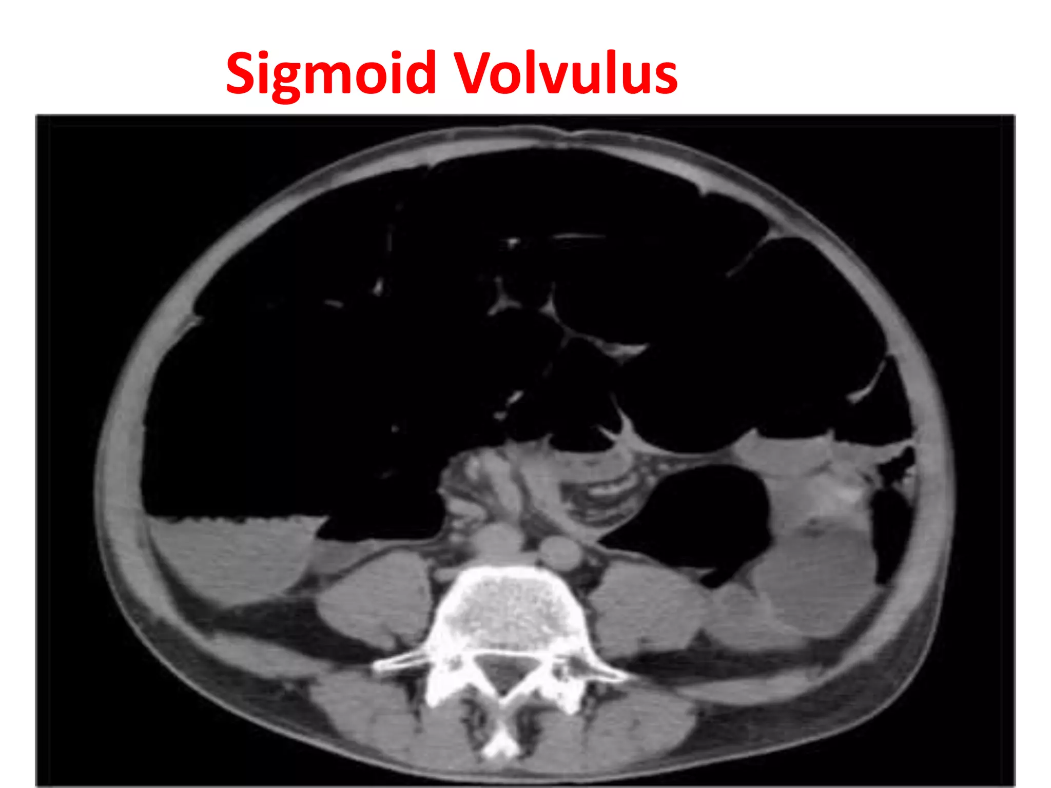 Volvulus of colon | PPTX