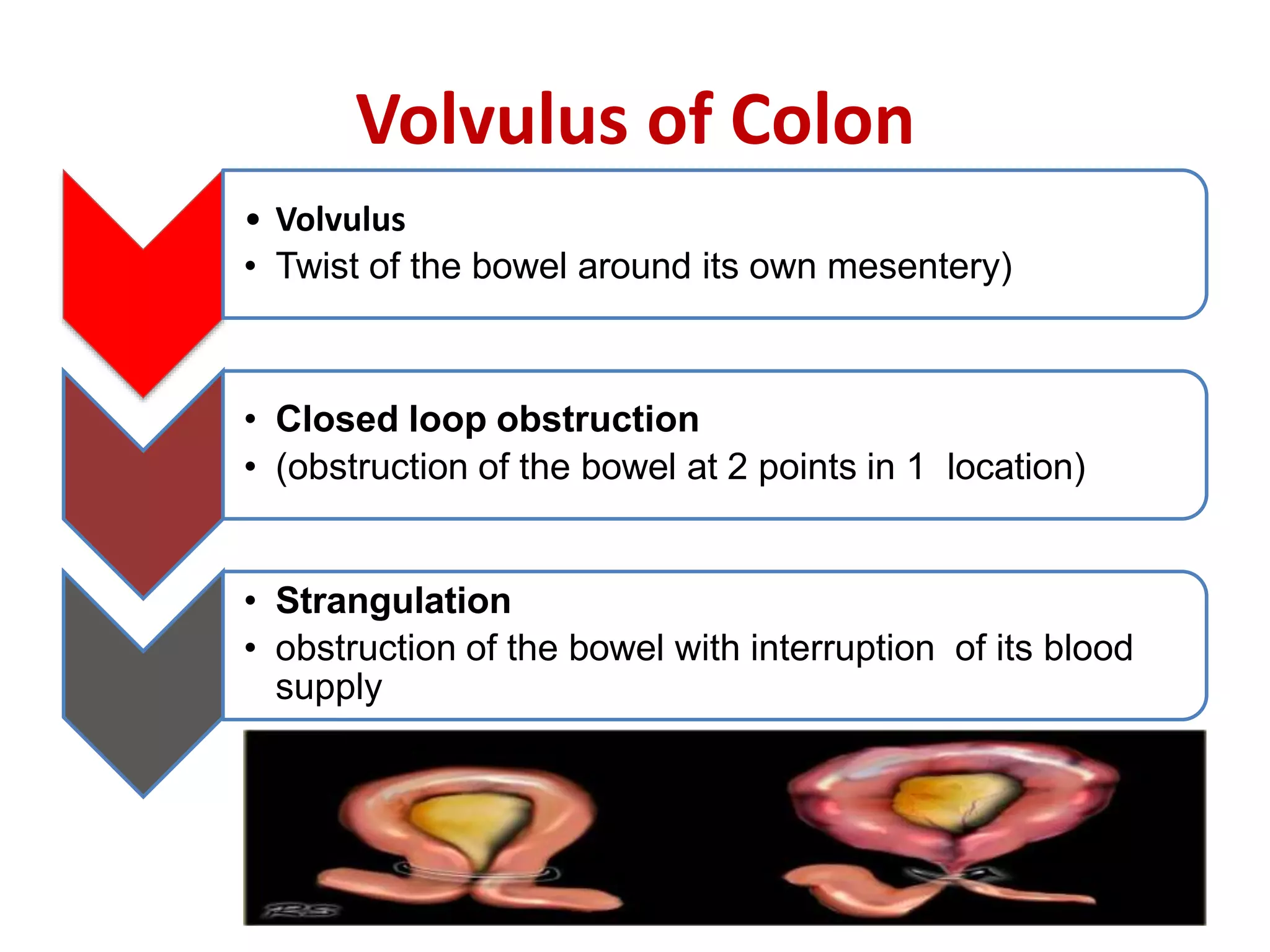 Volvulus of colon | PPTX