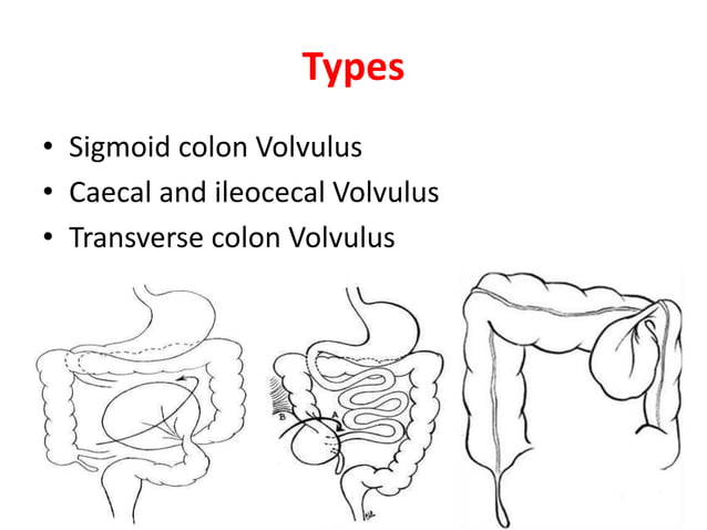 Volvulus of colon | PPTX