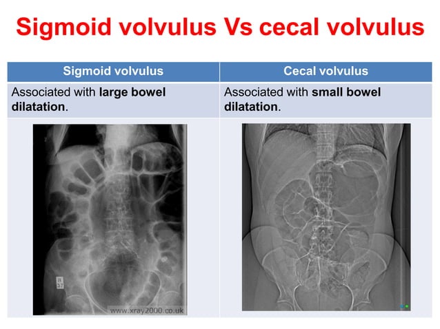 Volvulus of colon | PPTX