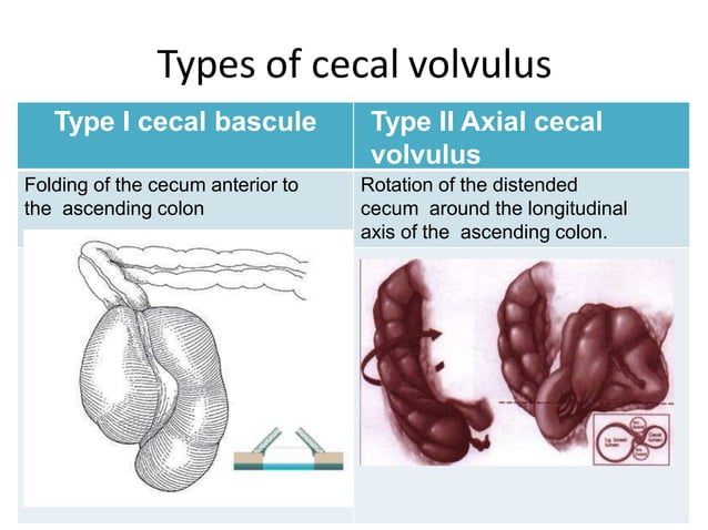 Volvulus of colon | PPTX