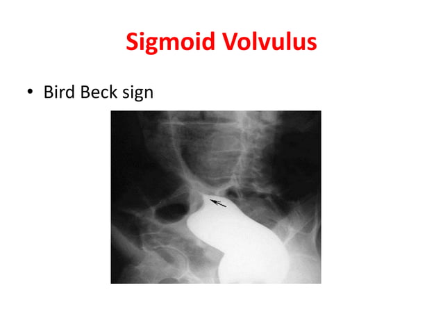 Volvulus of colon | PPTX
