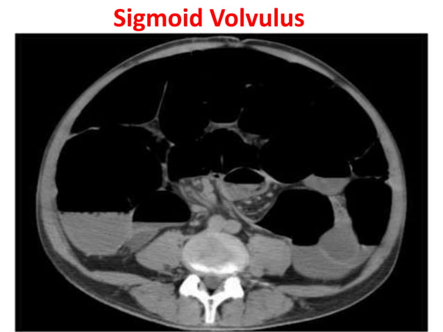 Volvulus of colon | PPTX