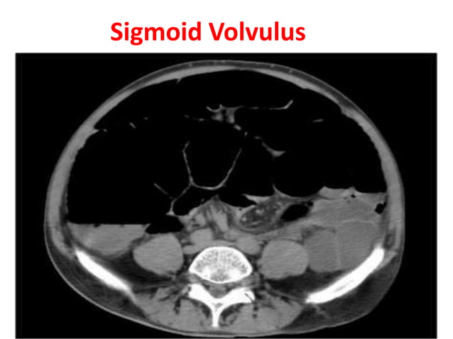 Volvulus of colon | PPTX