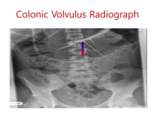 Volvulus of colon | PPTX