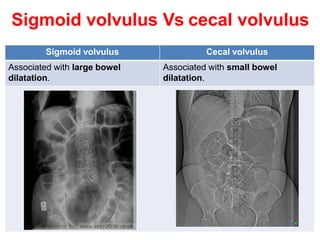 Learningradiology Cecal Volvulus Cecum Volvulous