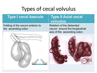 Cecal Bascule