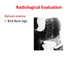 Sigmoid Volvulus Birds Beak