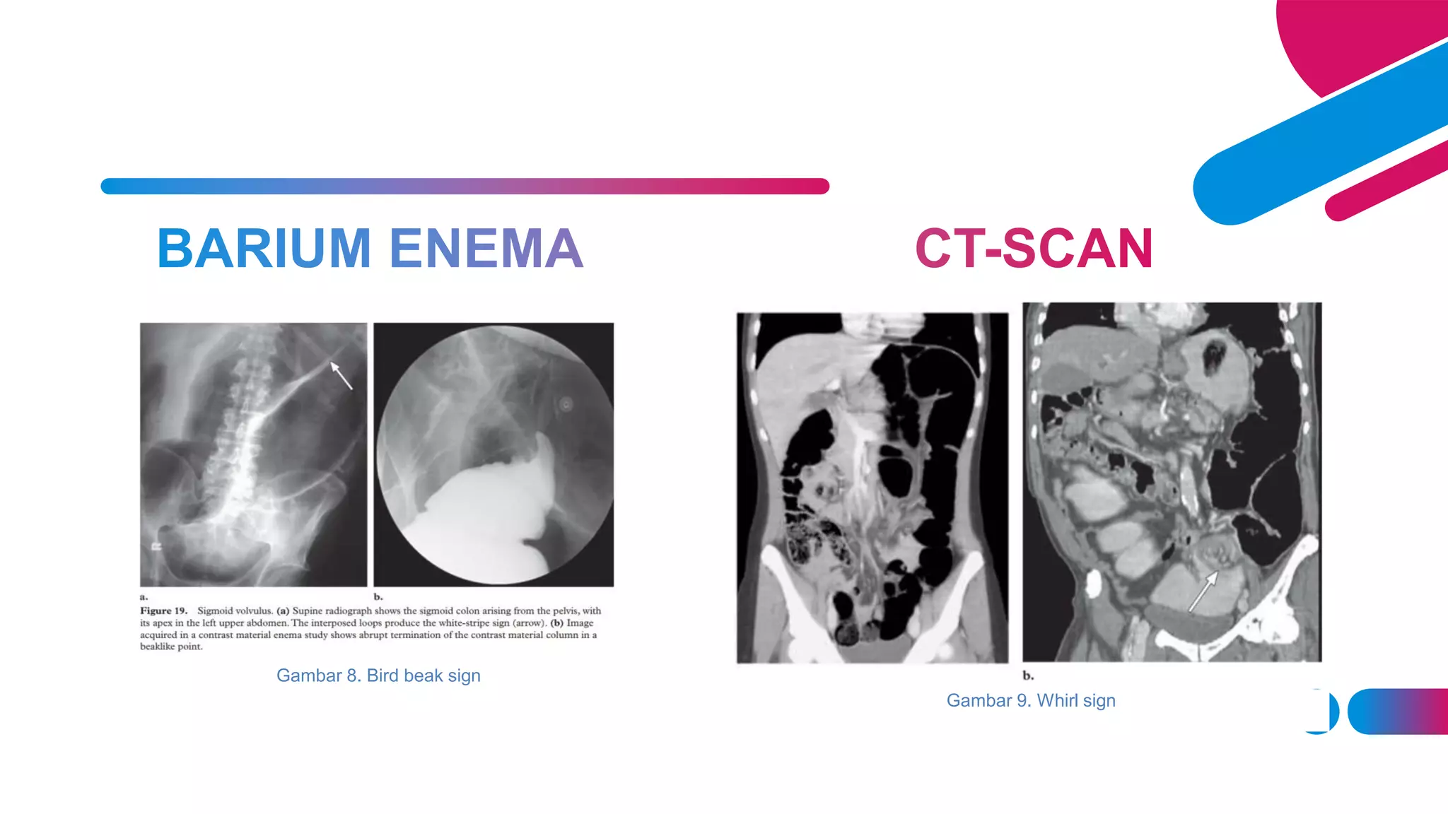 Refarat Volvulus Sigmoid | PPTX