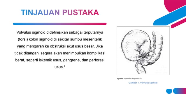 Refarat Volvulus Sigmoid | PPTX