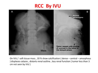 Von hippel –lindau disease | PPTX