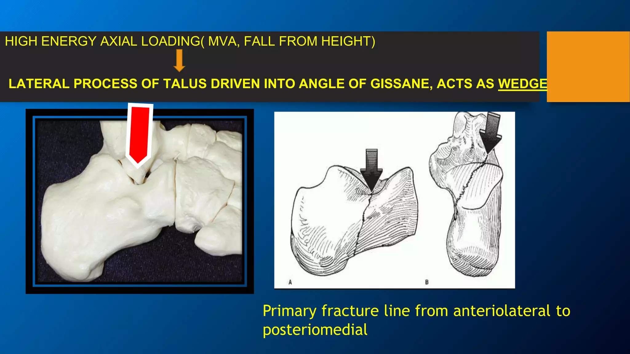 Calcaneum fracture- pathoanatomy & various fracture pattern | PPTX
