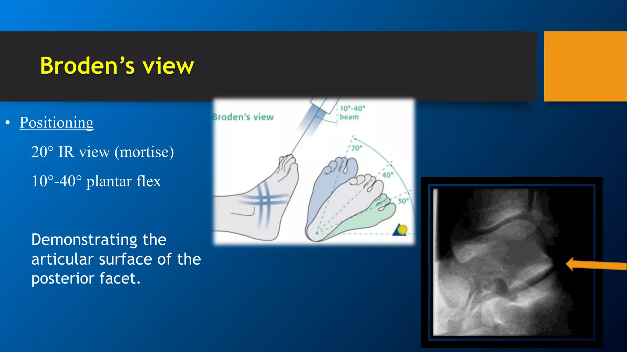 Calcaneum fracture- pathoanatomy & various fracture pattern | PPTX