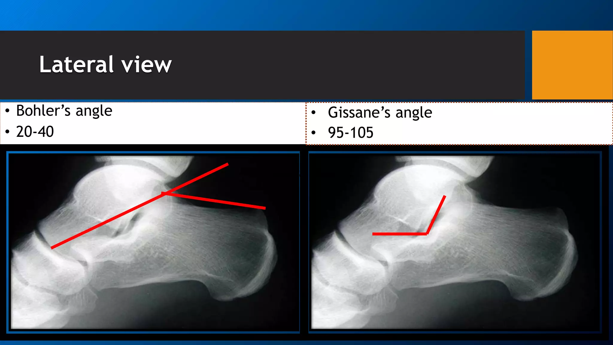 Calcaneum fracture- pathoanatomy & various fracture pattern | PPTX