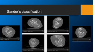 Calcaneum fracture- pathoanatomy & various fracture pattern | PPTX