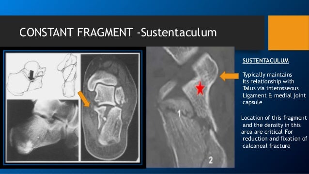 Calcaneum fracture- pathoanatomy & various fracture pattern