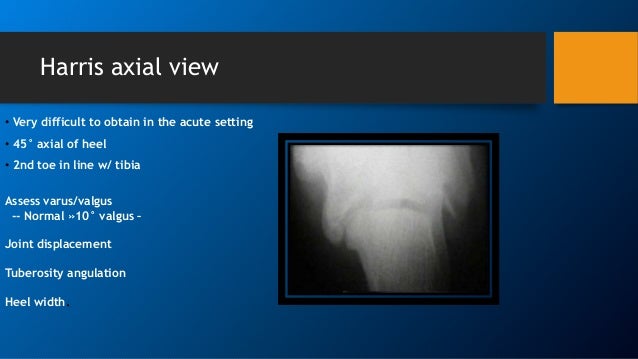 Calcaneum fracture- pathoanatomy & various fracture pattern