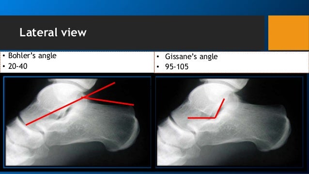 Calcaneum fracture- pathoanatomy & various fracture pattern