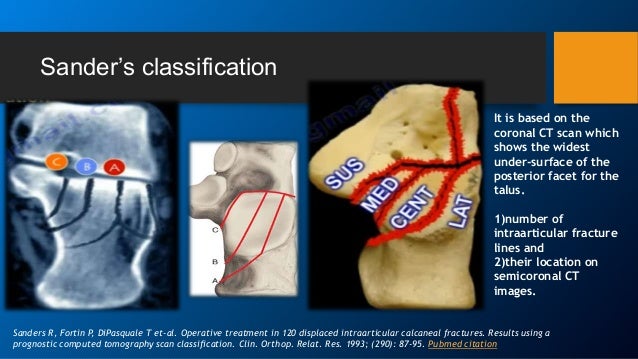 Calcaneum fracture- vpathoanatomy & various fracture pattern