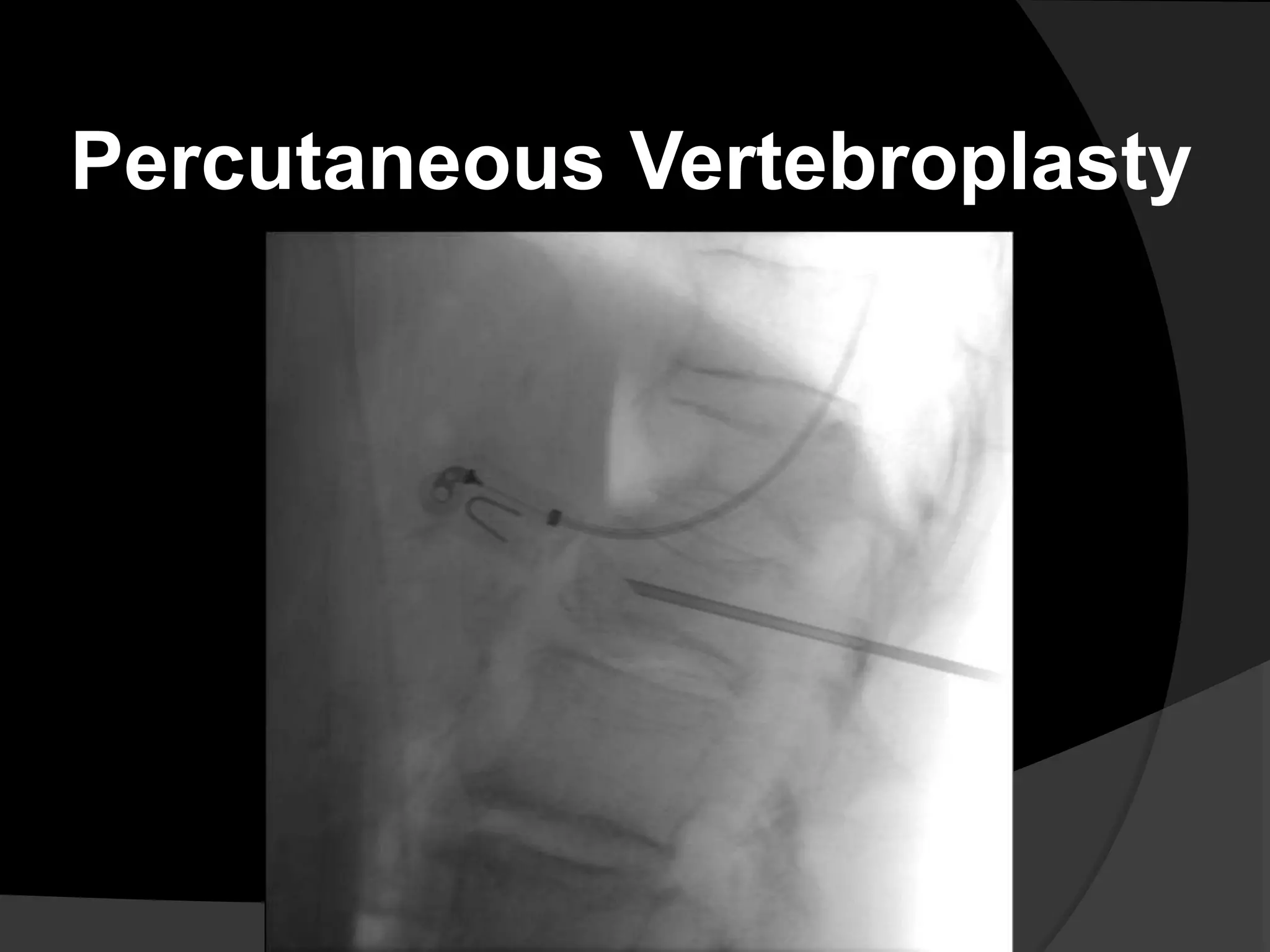 VERTEBROPLASTY | PPTX