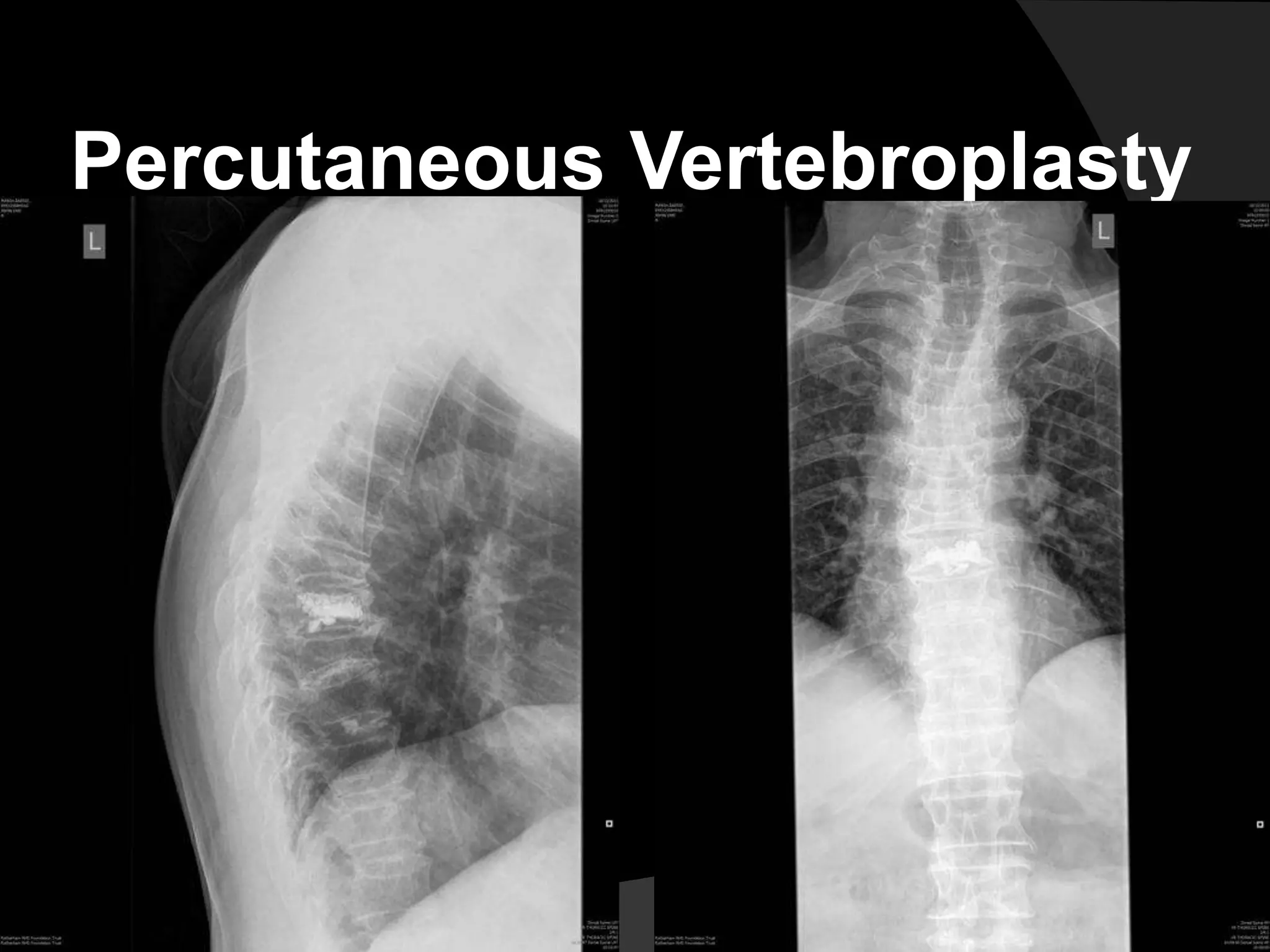 VERTEBROPLASTY | PPTX