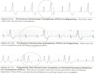Premature Ventricular Contractions Trigeminy